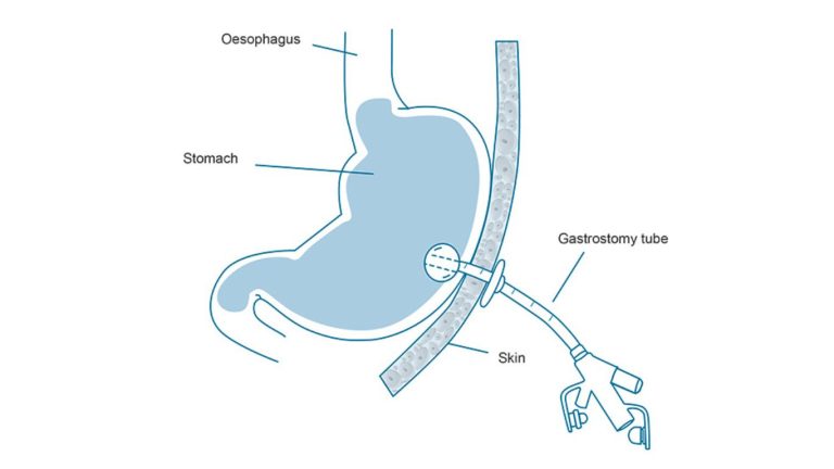 Understanding Percutaneous Endoscopic Gastrostomy (PEG)