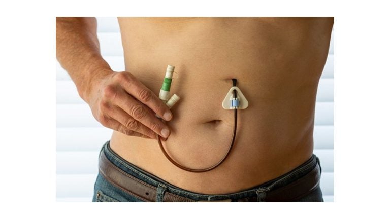 Understanding Percutaneous Endoscopic Gastrostomy (PEG)