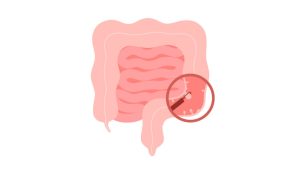 Flexible Sigmoidoscopy: Procedure, Preparation & Results